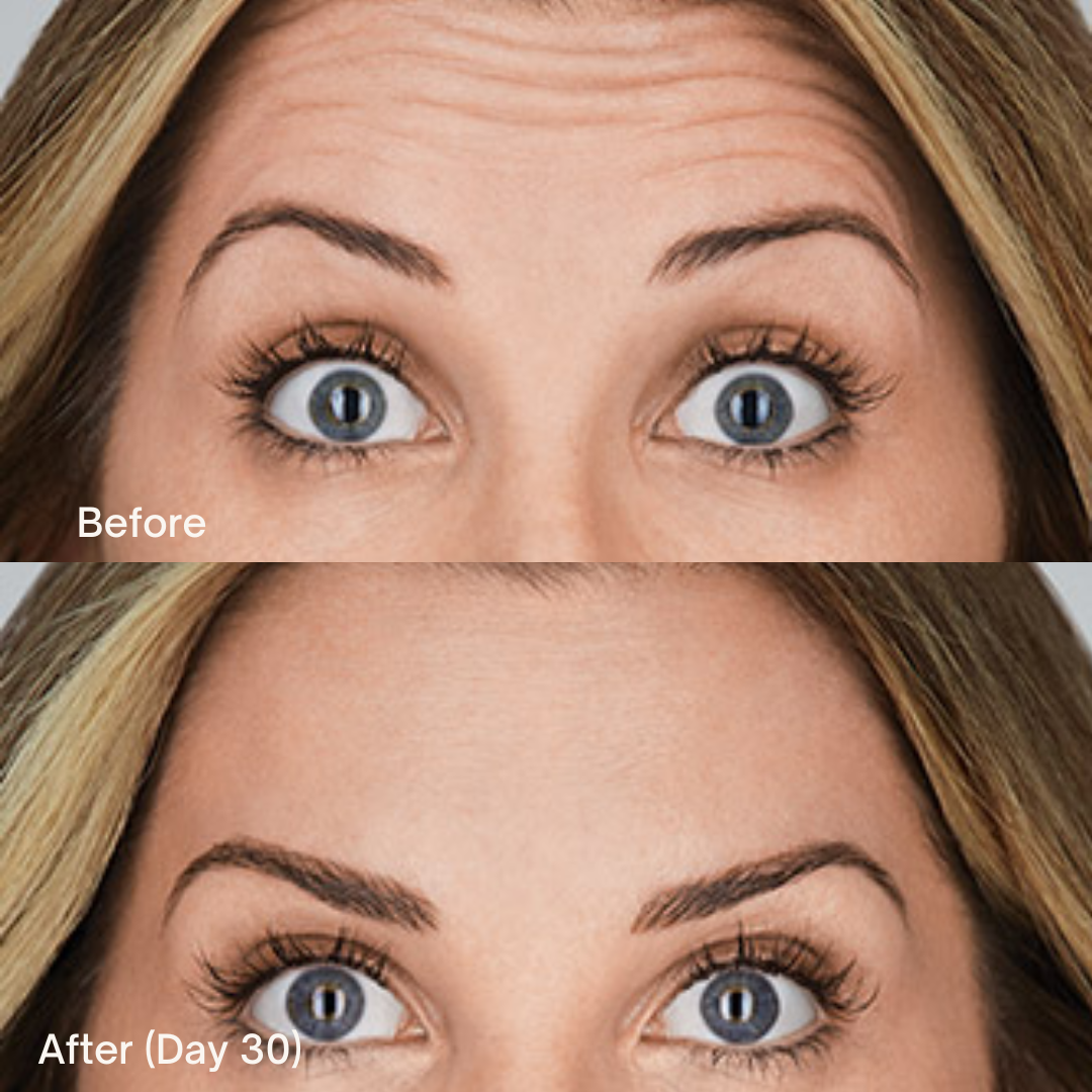 BOTOX® Cosmetic in Des Moines & Ankeny | Coachlight Clinic