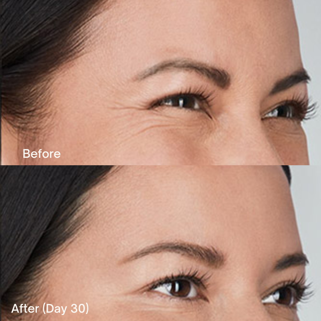 BOTOX® Cosmetic in Des Moines & Ankeny | Coachlight Clinic