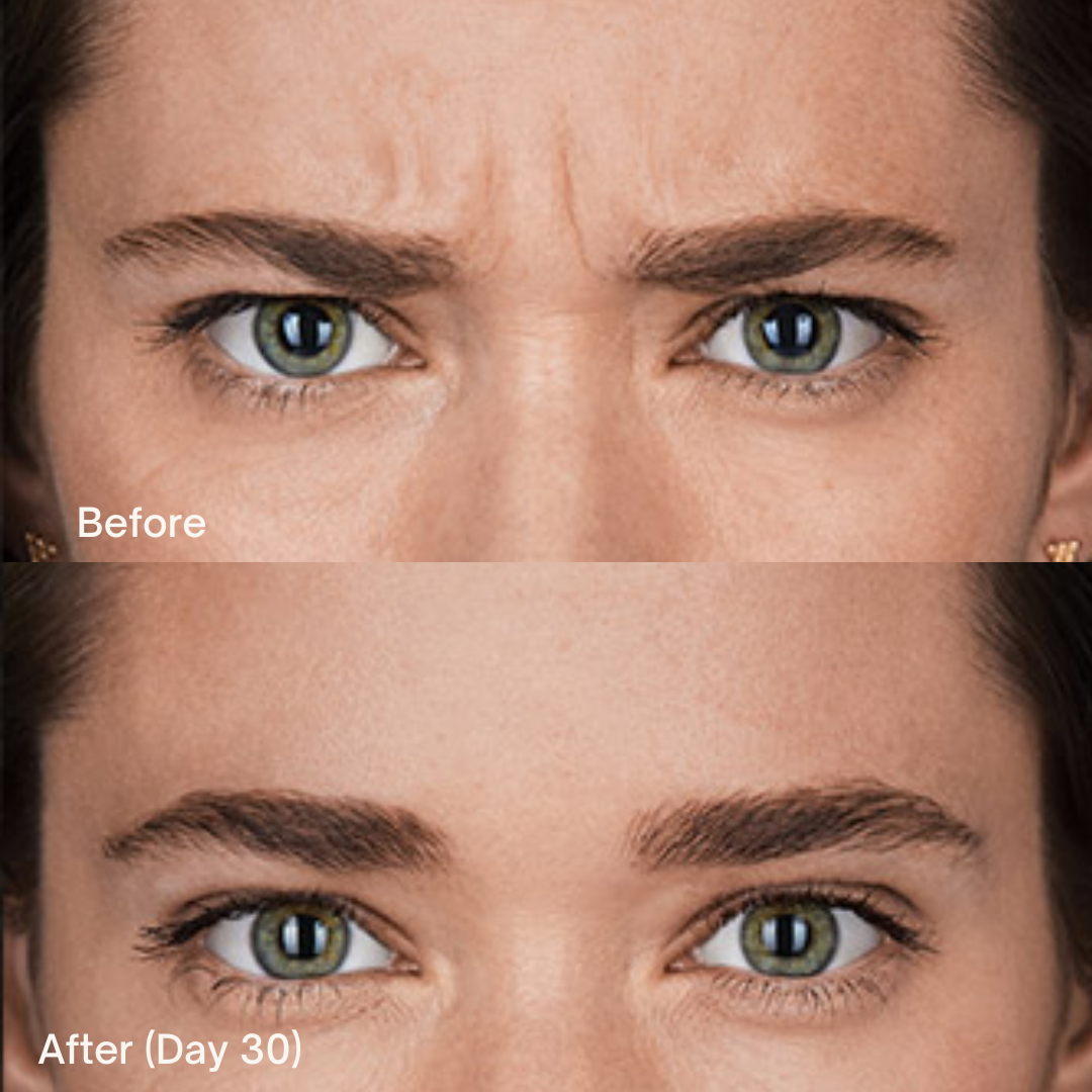 BOTOX® Cosmetic in Des Moines & Ankeny | Coachlight Clinic