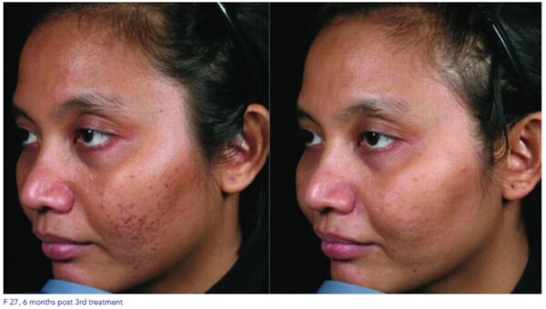 INTRAcel Microneedling in Des Moines & Ankeny | Coachlight Clinic