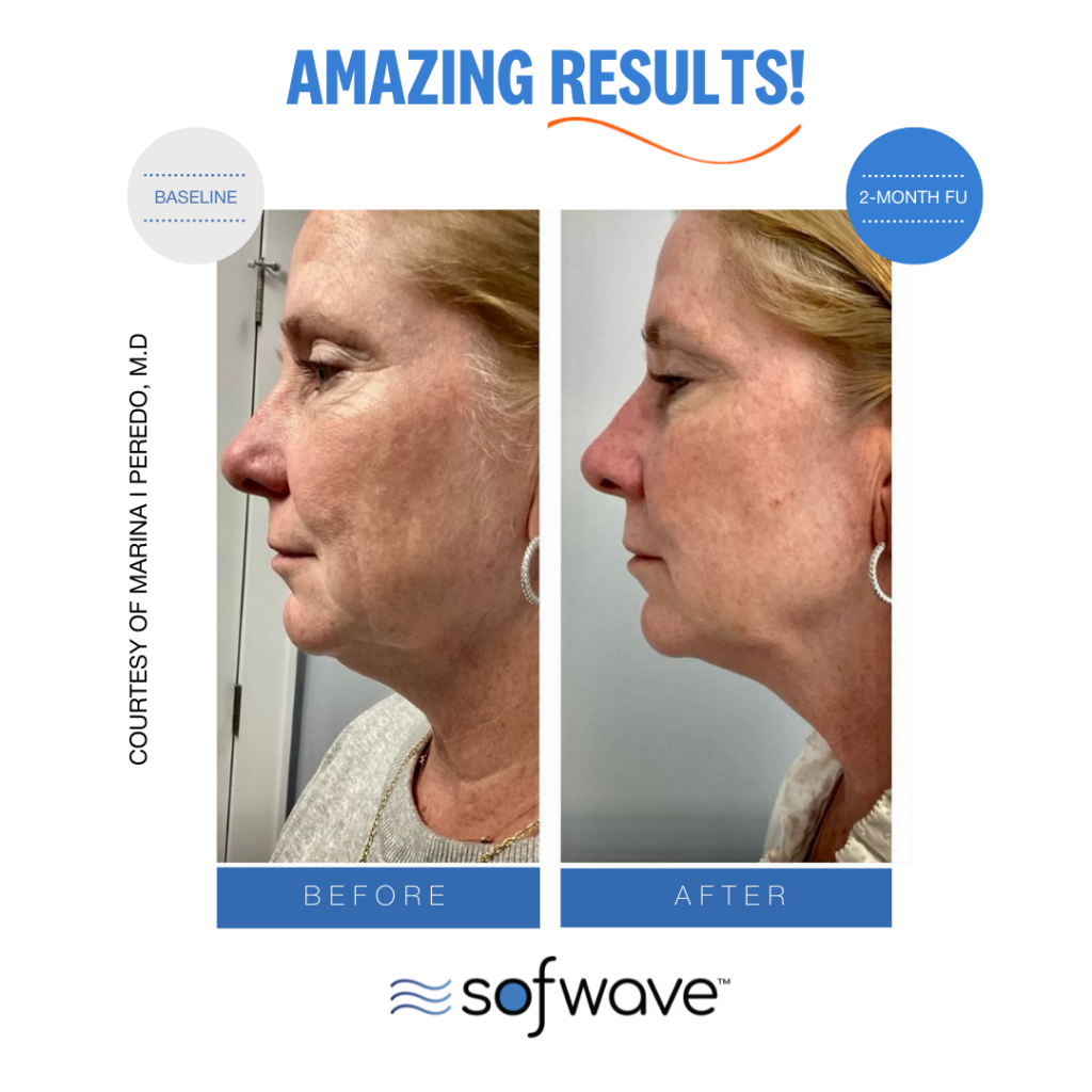 Sofwave Before & After Gallery | Coachlight Clinic & Spa