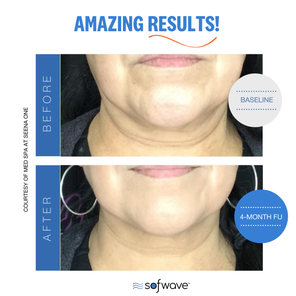 Sofwave Before & After Gallery | Coachlight Clinic & Spa